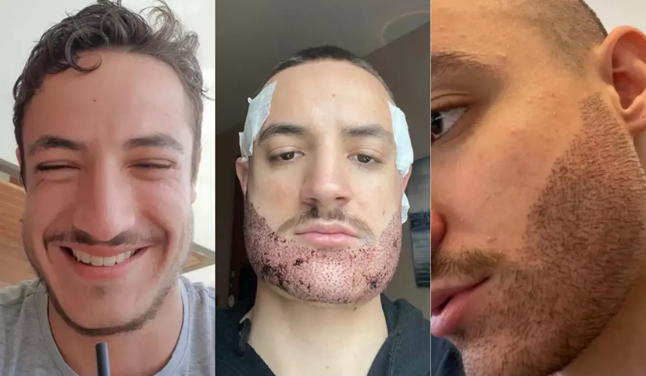 Mathieu, 24 ans, met fin à ses jours à cause d’une greffe de barbe ...